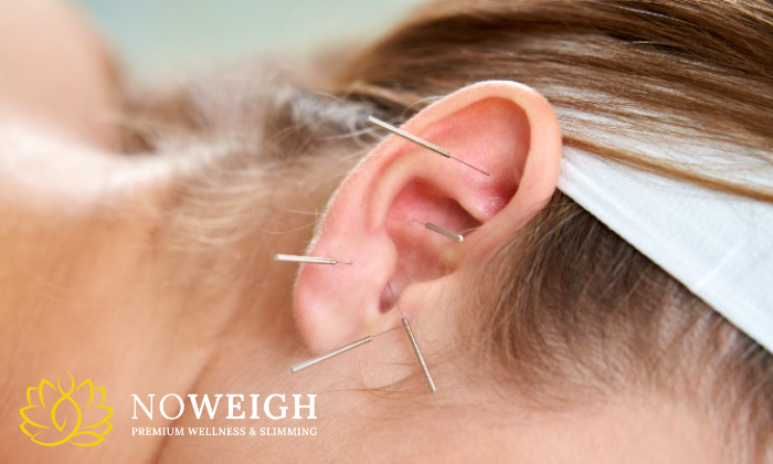 2 or 3 x Acudetox Acupuncture Sessions – Hyperli